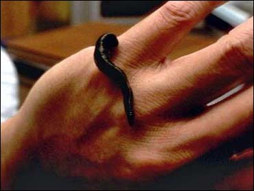 Live Leech Hid In Woman's Sinus - CBS News