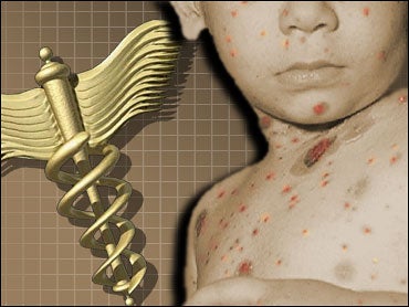 Chicken Pox Vaccine Doing The Job - CBS News