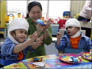Separated Twin Takes First Steps - CBS News