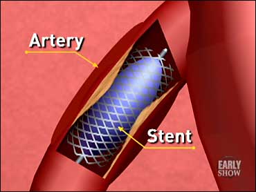 New Brain Stent Opens Blocked Arteries - CBS News