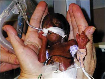 Smallest Surviving Baby Heads Home - CBS News