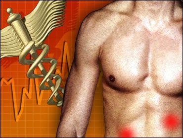 Colon Polyp Return Likelier In Men? - CBS News