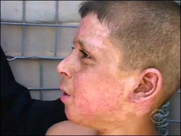 Iraq's Burn Unit Working Miracles - CBS News