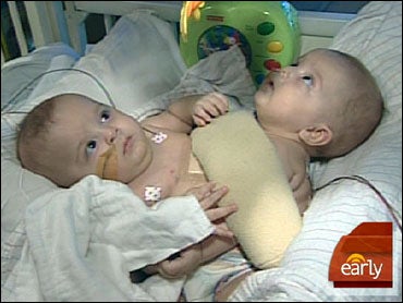 Surgery Separates Conjoined Twins - CBS News