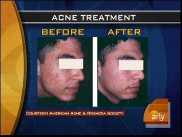 "Super Acne" Is Super Difficult To Treat - CBS News