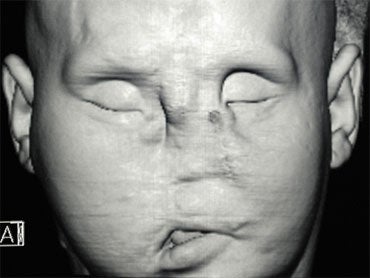 First Full-Face Transplant Claimed in Spain - CBS News