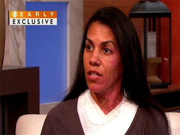 Acid Attack Victim: I Was Targeted - CBS News
