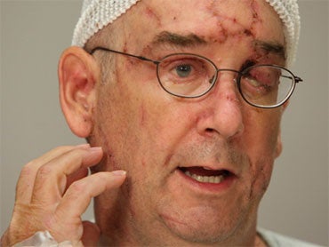 Bear-Mauling Victim Recounts "Horrendous Fight" - CBS News