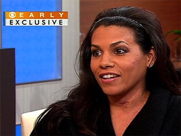 Acid Attack Victim: Scars More than Skin-Deep - CBS News