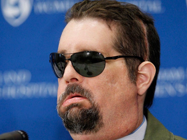 First full face transplant recipient in U.S., Dallas Wiens, smiles ...