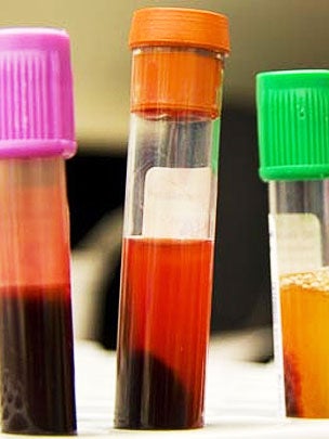 Depression blood test for teens may lead to better treatment, less ...