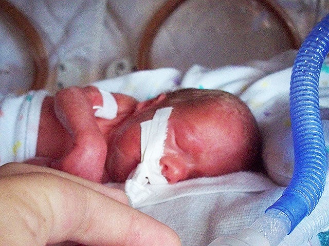 Born prematurely? You risk heart failure as adult, study suggests - CBS ...