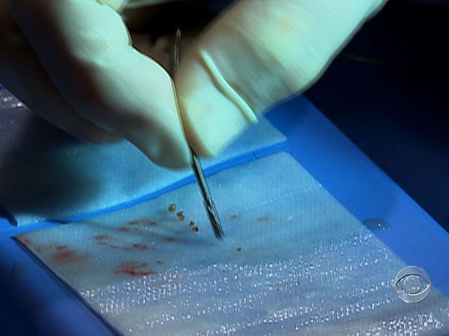 Stem cells heal heart attack scars, regrow healthy muscle - CBS News