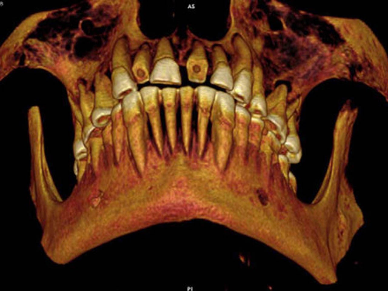 Mummy discovered with mouthful of cavities - CBS News