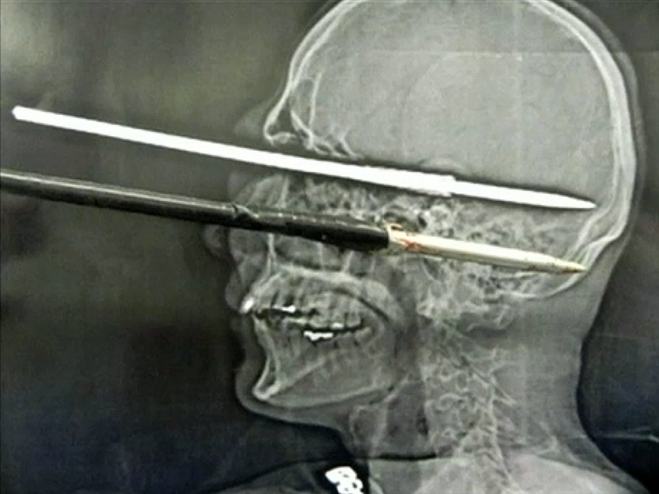 Man survives harpoon through skull with no brain damage - CBS News