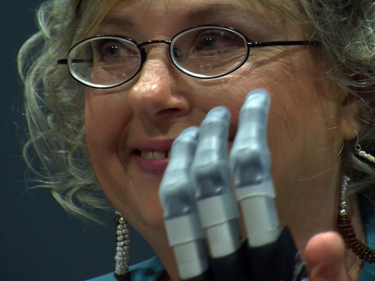 Prosthetics give woman new fingers, toddler a leg - CBS News
