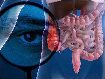 FDA panel backs non-invasive colon cancer screening alternative - CBS News