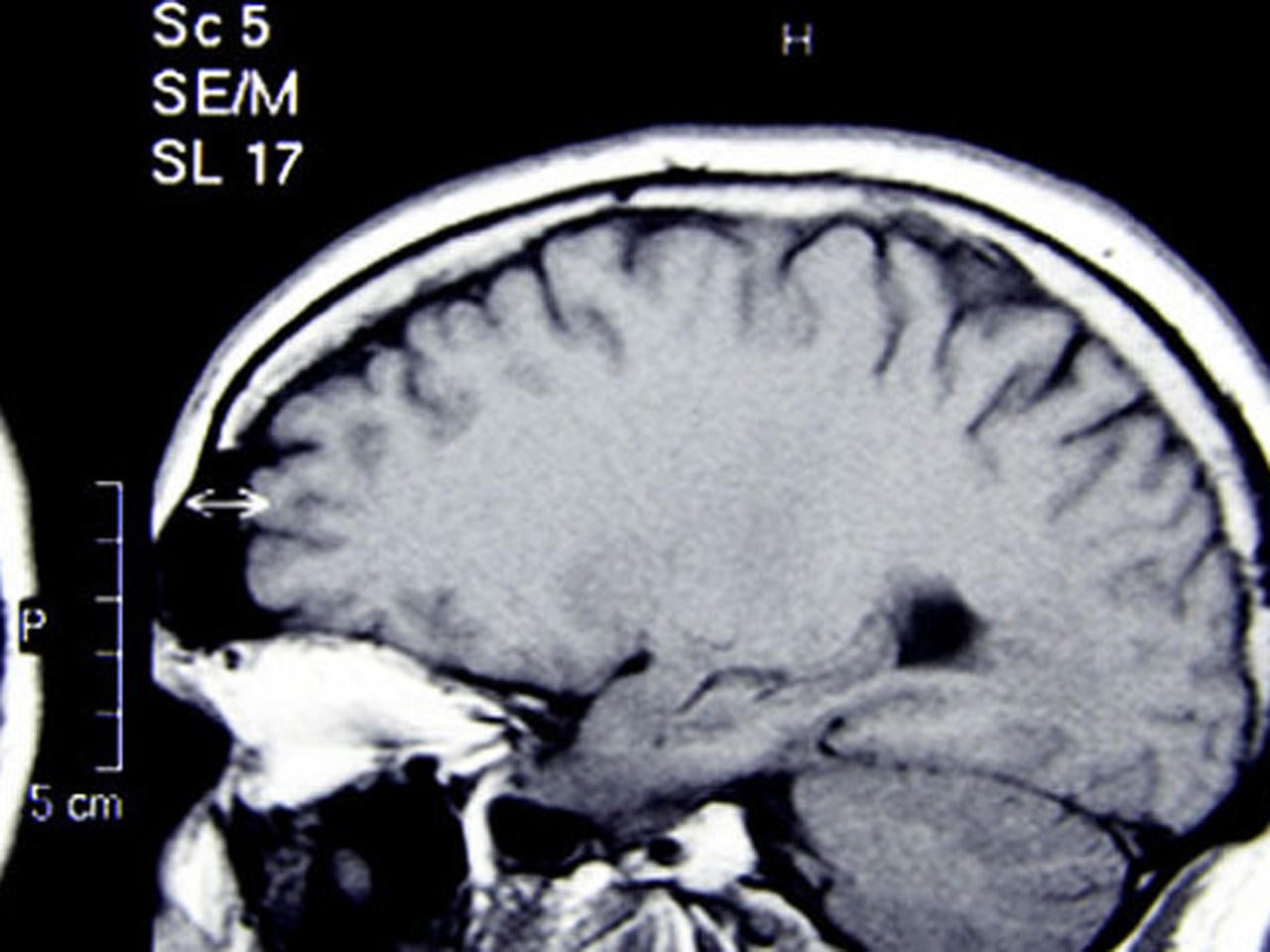 Type 2 diabetes may shrink the brain, study suggests - CBS News