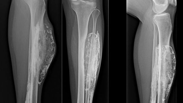 Snakebite causes huge mass in woman's leg, 50 years later - CBS News