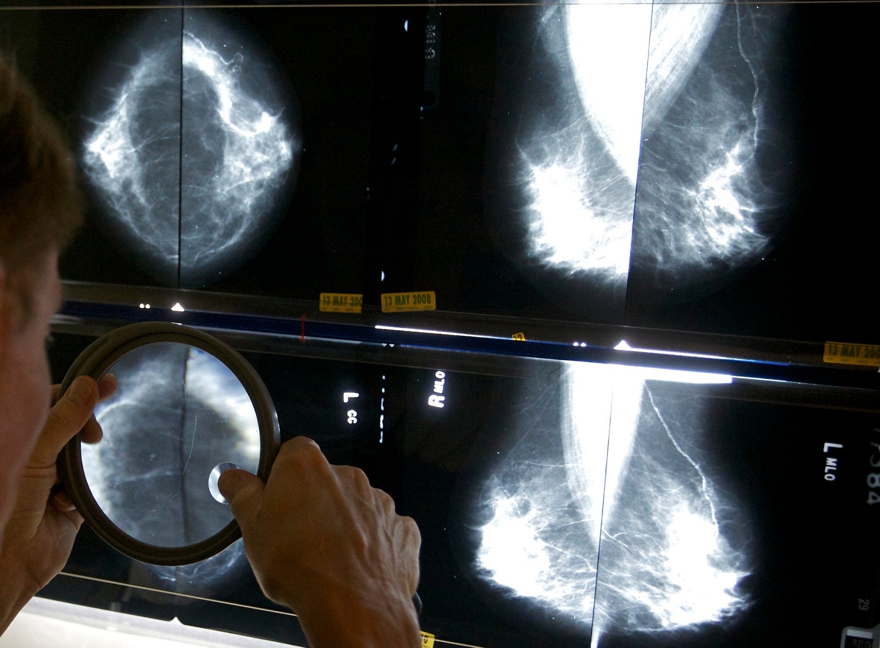 Breast biopsies often get it wrong - CBS News