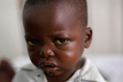 AP: UN bungled response to Africa's yellow fever outbreak - CBS News