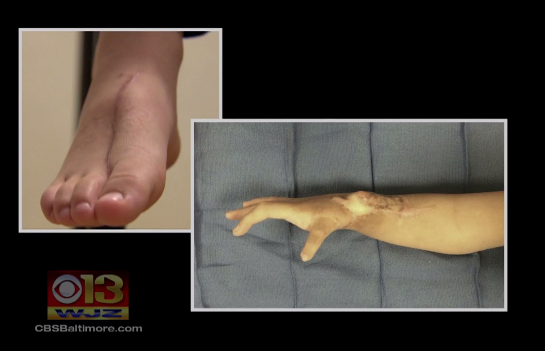 Baltimore surgeon gives boy new hand using his foot bones - CBS News