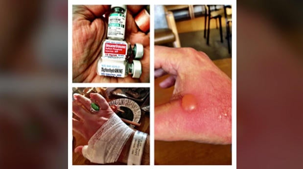 Minnesota man burned squeezing limes in the sun - CBS News