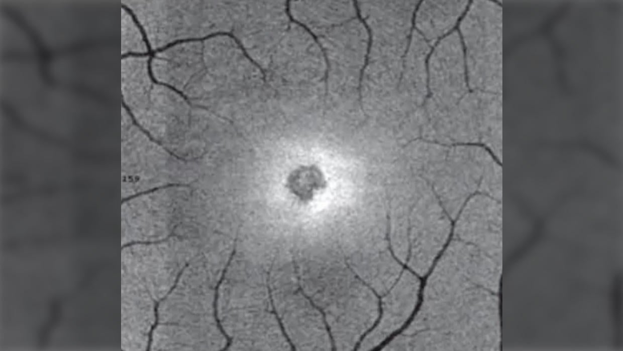 Solar eclipse damage to woman's eye revealed in striking images - CBS News