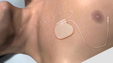 Implantable device to control sleep apnea wins FDA approval - CBS News