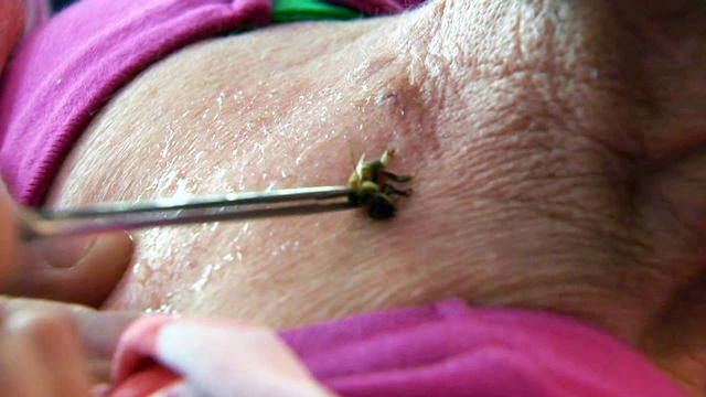 Bee sting therapy for osteoarthritis joint pain may go mainstream - CBS ...
