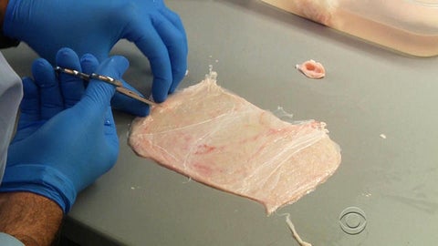 Patients regrow muscles with pig bladder tissue - CBS News