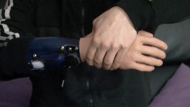 Three men receive mind-controlled bionic hands - CBS News