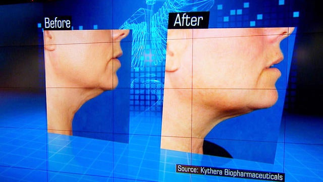 FDA approves Kybella, new drug treatment for double chins - CBS News