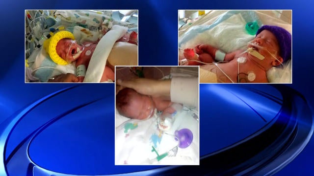 Identical triplet girls, two conjoined, born in Texas - CBS News