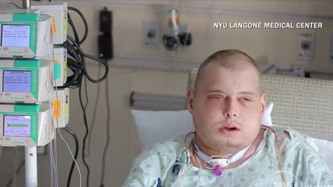 "Most extensive" face transplant patient, firefighter Patrick Hardison ...