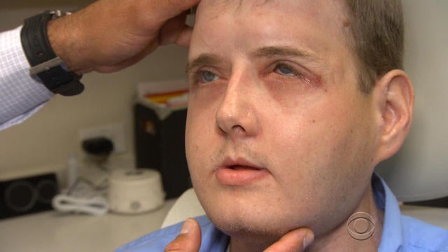 Face transplant recipient Patrick Hardison, one year later - CBS News