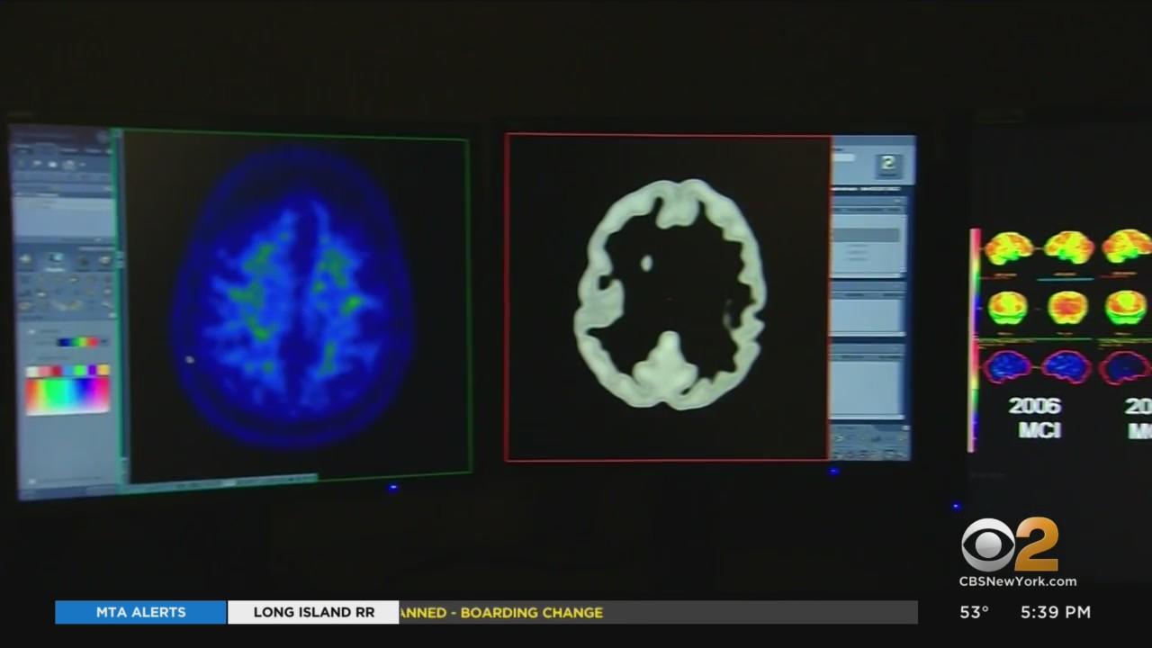 Landmark study finds dozens of genes connected to Alzheimer's - CBS New ...