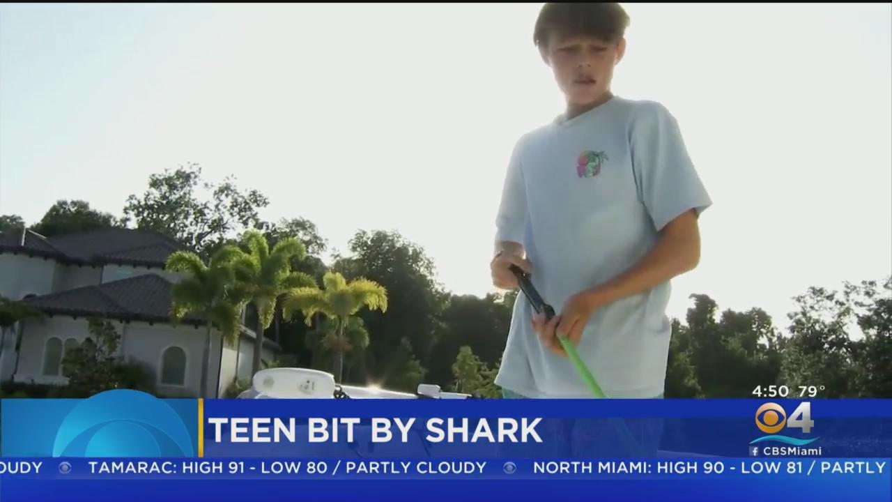 Teen bitten in the face by a shark in Florida Keys - CBS Miami