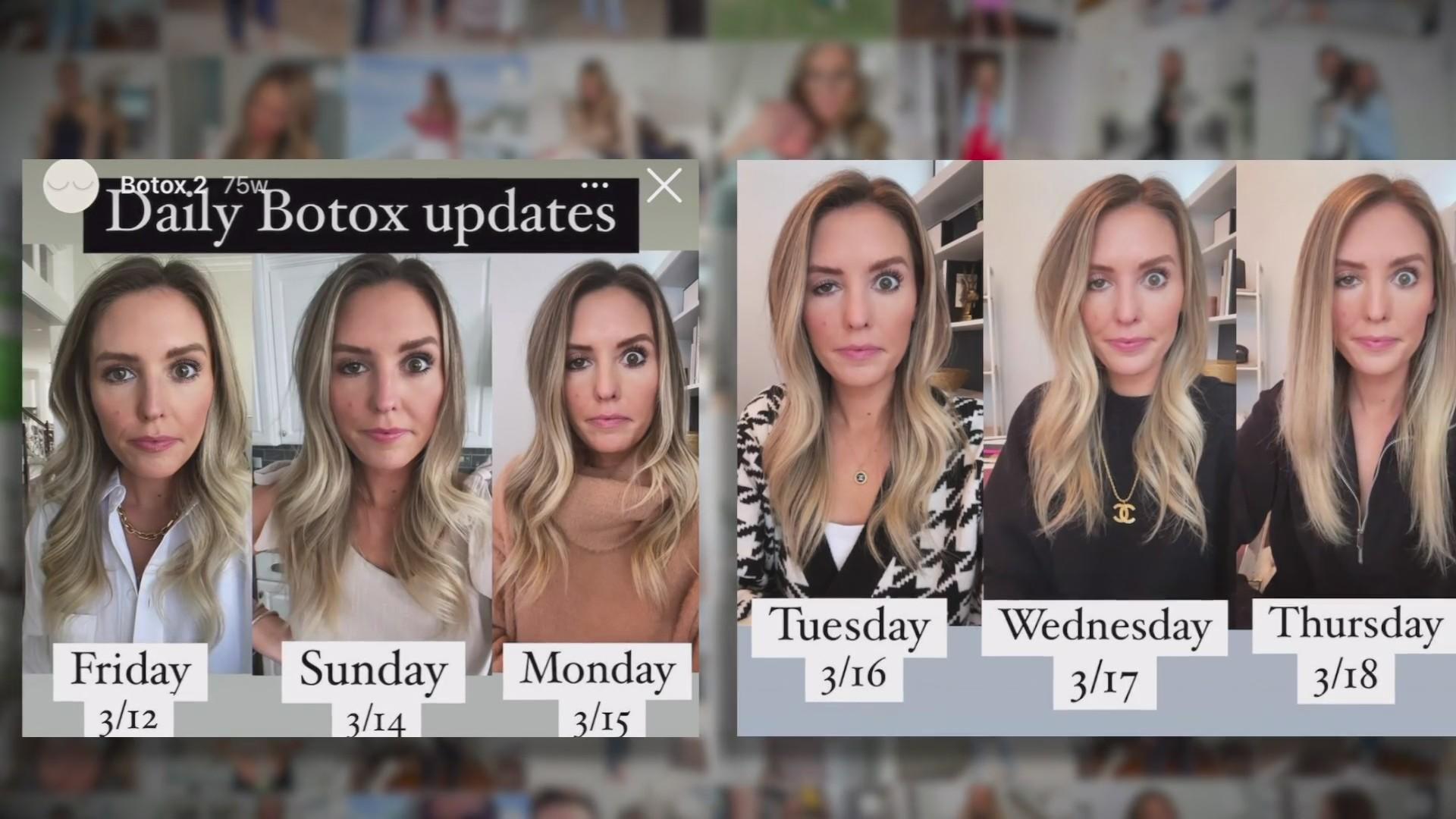 Chicago influencer shares tale of bad botox treatment; "I look like Two ...
