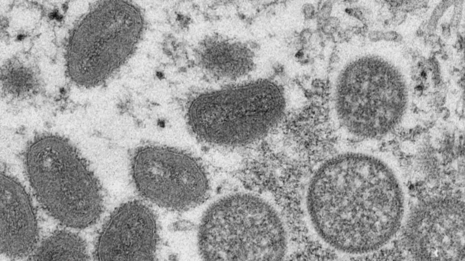 2 die in Chicago after contracting monkeypox - CBS Chicago