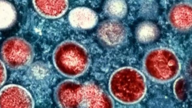 Health agencies renaming "monkeypox" as "mpox" to help fight stigma ...