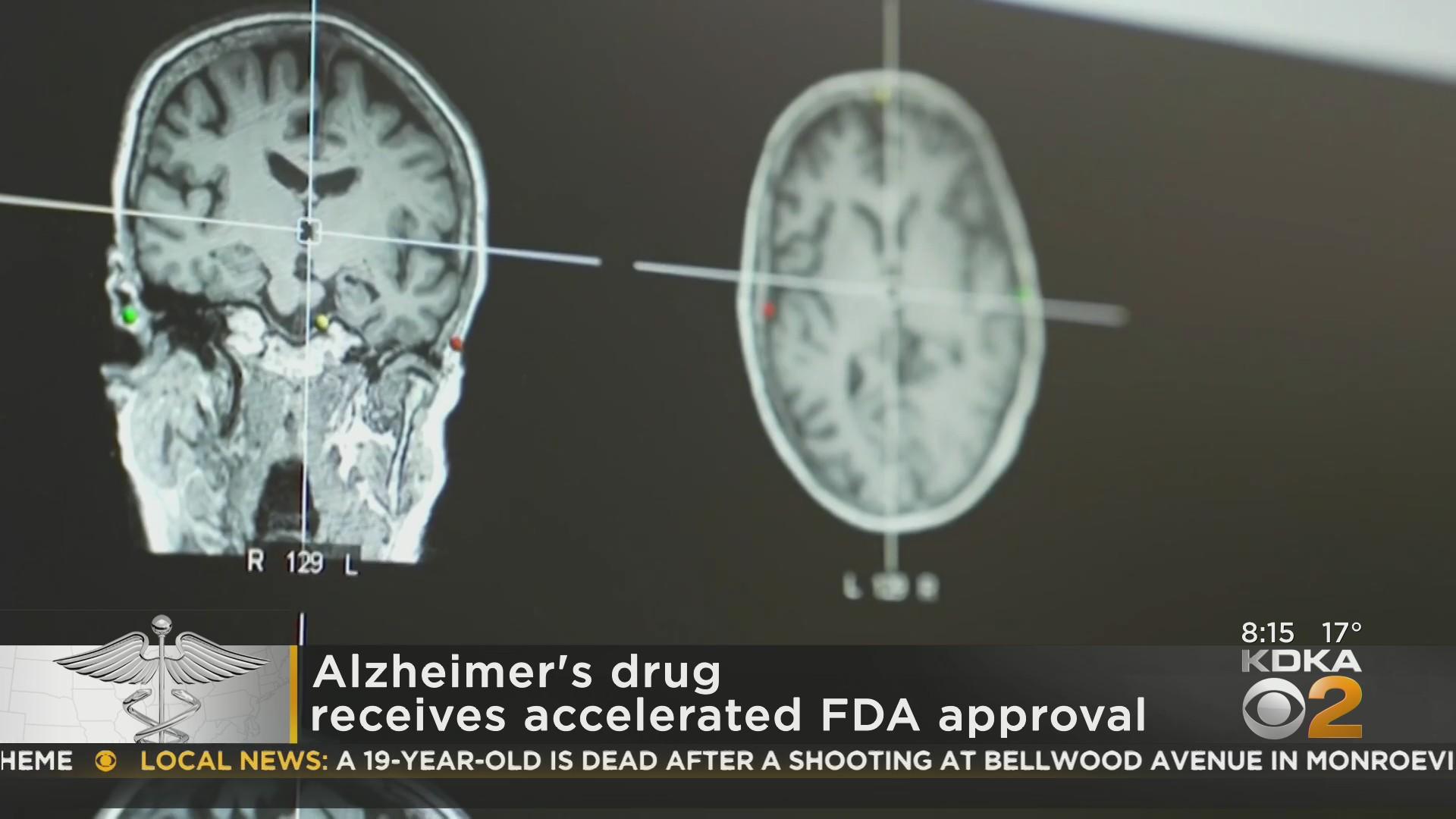 New Alzheimer's drug receives accelerated FDA approval - CBS Pittsburgh
