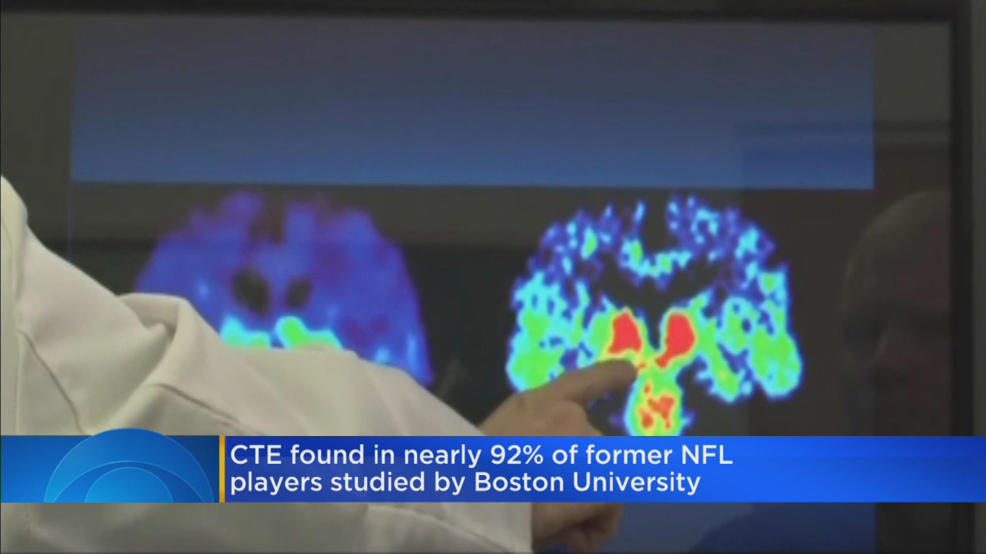 CTE found in nearly 92% of former NFL players studied by Boston ...