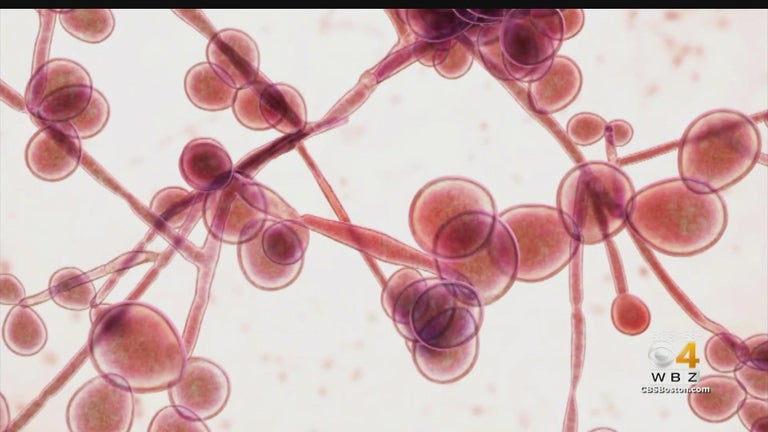 CDC warns cases of dangerous fungus rising quickly in U.S. - CBS Boston