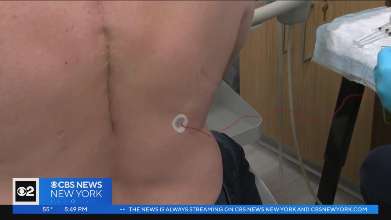 FDNY firefighter injured on 9/11 shares scar dancing syndrome diagnosis ...