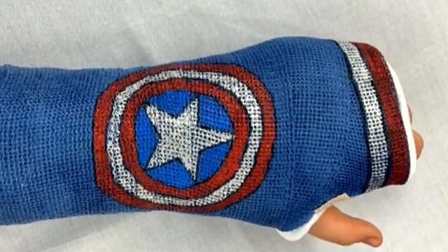 Chicago children's doctor brings smiles to patients with cast art - CBS ...