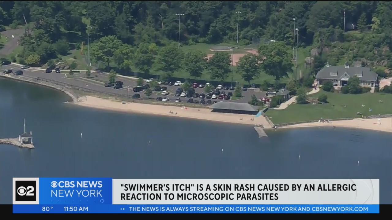 Greenwich beaches see uptick in cases of swimmer's itch, caused by ...