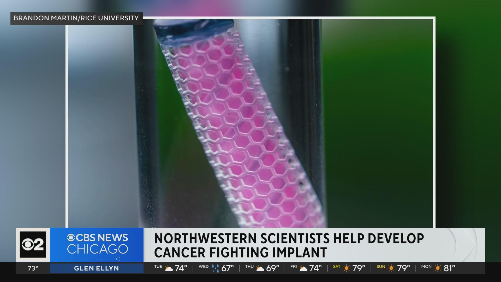 Northwestern developing implant to sense and treat cancer - CBS Chicago