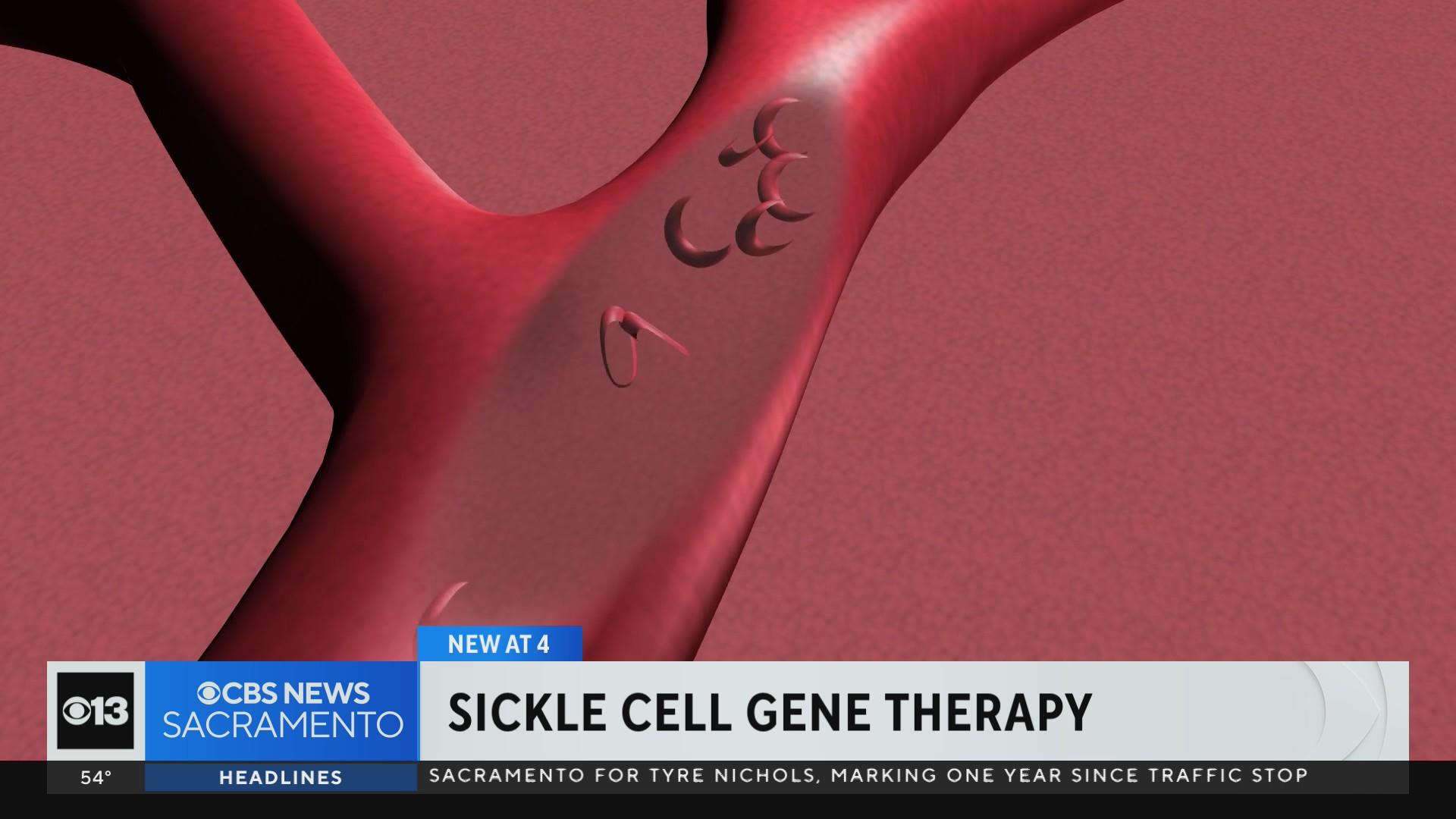 CRISPR gene-editing therapy approved by FDA for sickle cell treatment - CBS Sacramento