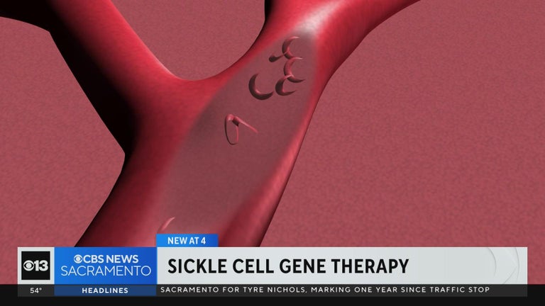 CRISPR gene-editing therapy approved by FDA for sickle cell treatment - CBS Sacramento